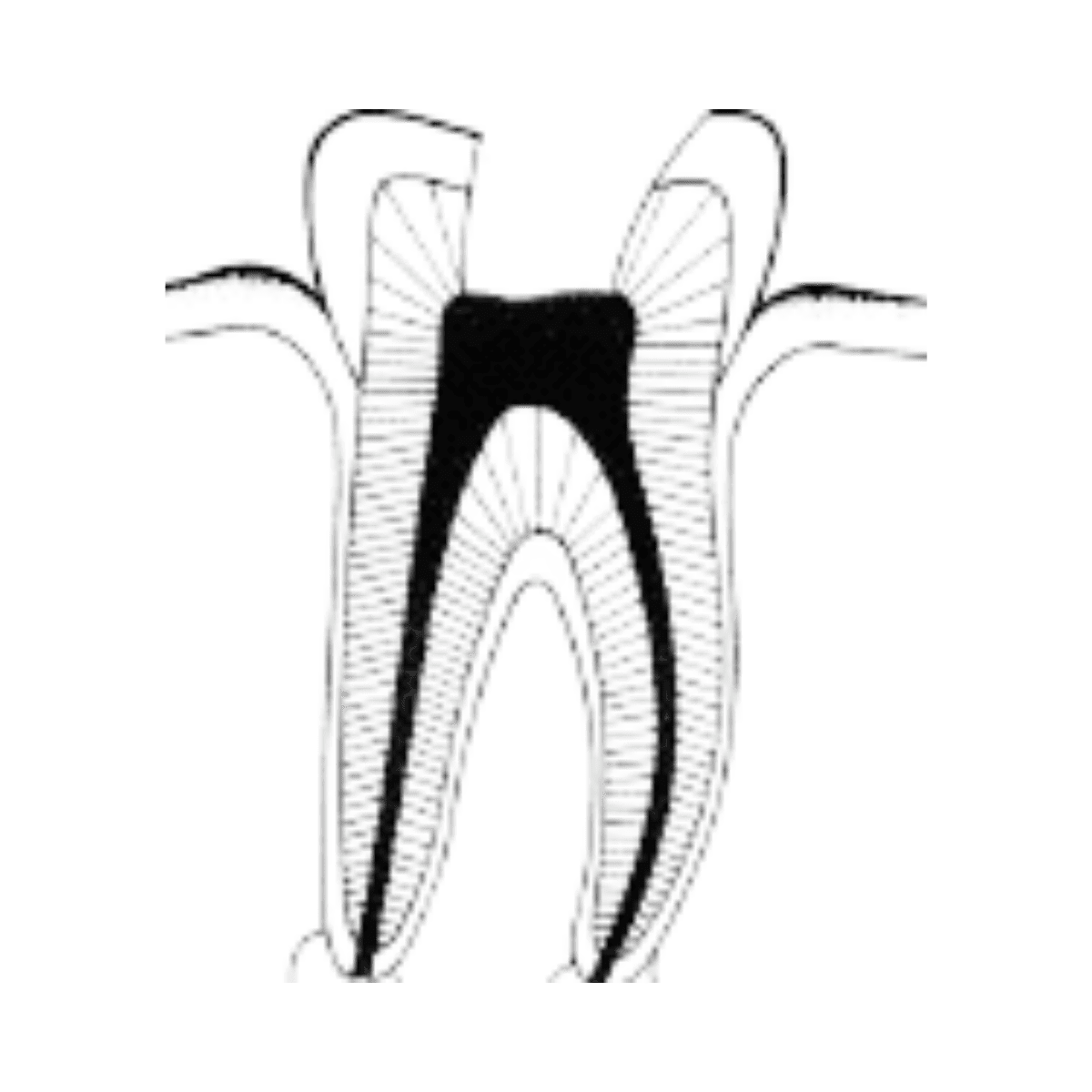 Root Canals - Panmure Dentists